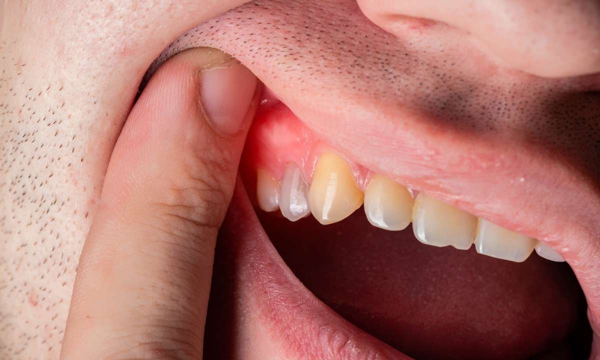 Decoding Dreams About Gum Stuck In Teeth